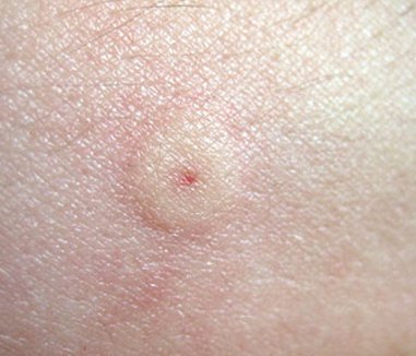 Kako pravilno tretirati mjesto na kojem vas je ubola osa ili pčela ...